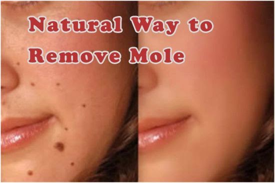 Natural Mole Removal ~ Iamjeni